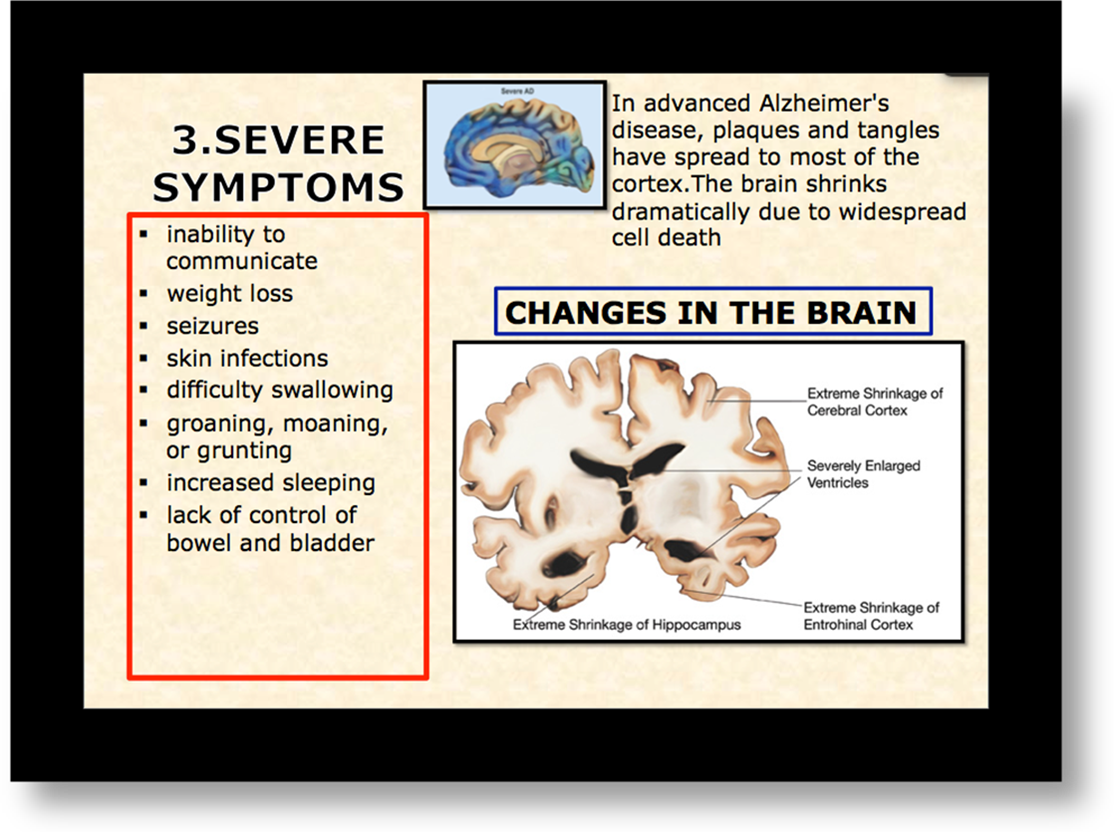 Stages of Alzheimer’s Disease – Dementia Awareness Research Group of ...